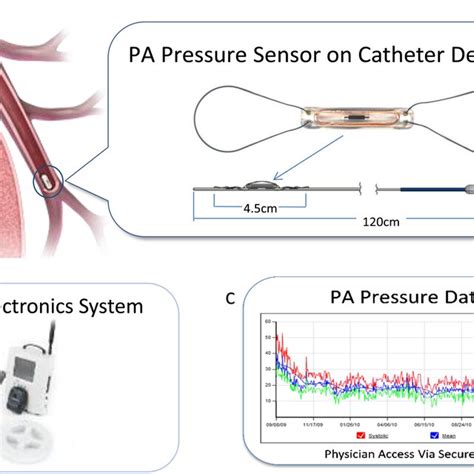 The Cardiomems Tm Hf System Sensor Is Permanently Implanted Into The Download Scientific