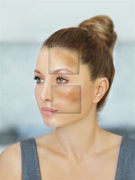 Melasma Vs Hyperpigmentation Sacred Rituel Beauty