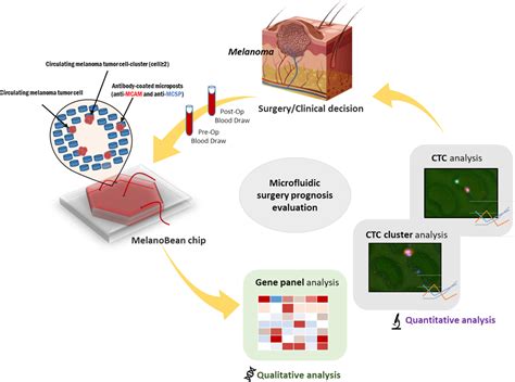 Isolation Of Circulating Tumor Cells To Diagnose Melanoma And Evaluate