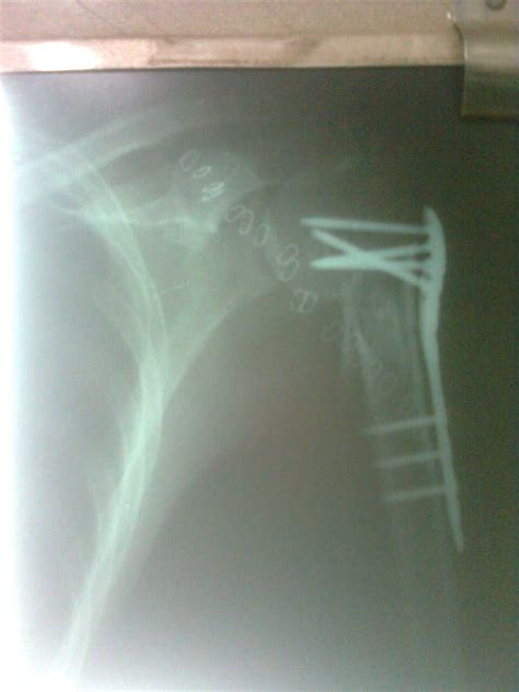 Proximal Humerus Fractures Trauma Orthobullets
