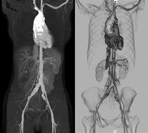 An Adult Fatal Case With A Stat1 Gain Of Function Mutation Associated With Multiple Autoimmune