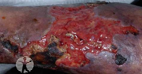 Pyoderma Gangrenosum Image