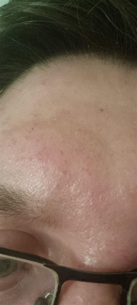 What Is Causing My Forehead Rash R Dermatology