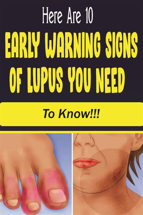 Here Are 10 Early Warning Signs Of Lupus You Need To Know