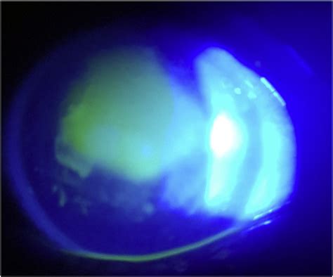 Acute Ocular Surface Inflammation In The Right Eye Before Amniotic Download Scientific Diagram