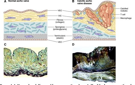 Figure 1 1 From Characterization Of Sex Differences In Aortic Valve