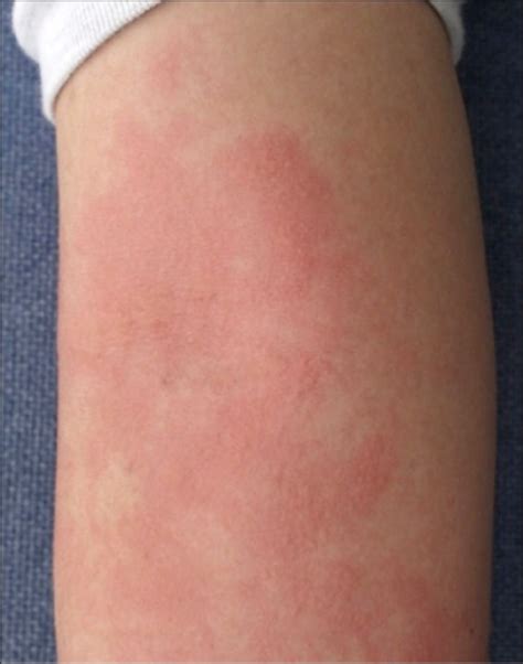 Aquagenic Urticaria Causes Diagnosis Facts And Treatment