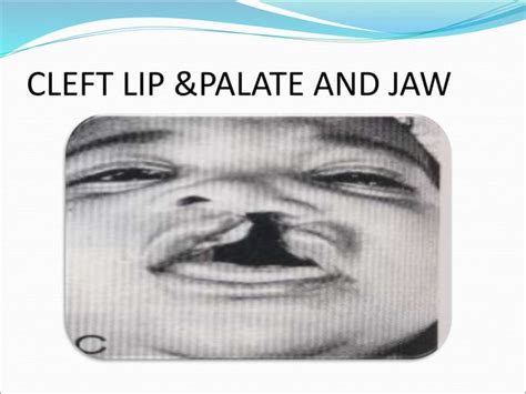 Development Of Palateppt