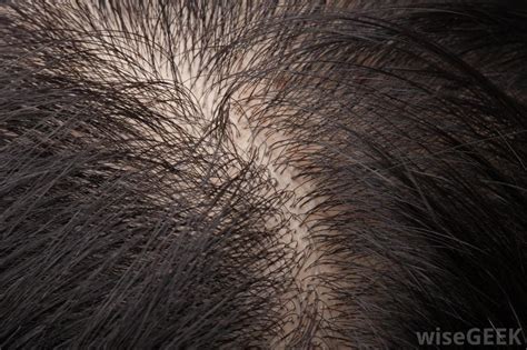 Scalp Infection Causes And Types