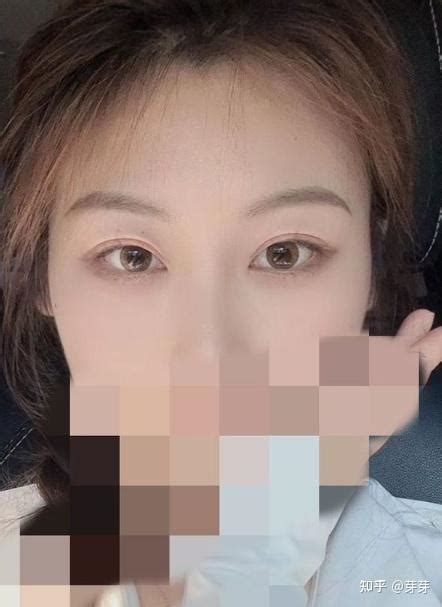 武汉双眼皮手术医生哪位好 曹玮徐逸李芸田霞严玲玲方涛邵芳各位优势 已做 知乎