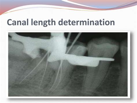 Parallel Angle Technique Vs Bisecting Angle Technique Pptx Dental