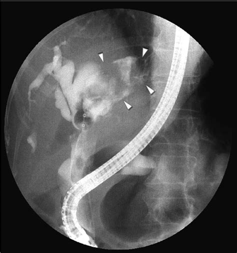 Cholangiogram Catheter