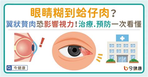 眼睛糊到蛤仔肉？翼狀贅肉恐影響視力！治療及預防一次看懂
