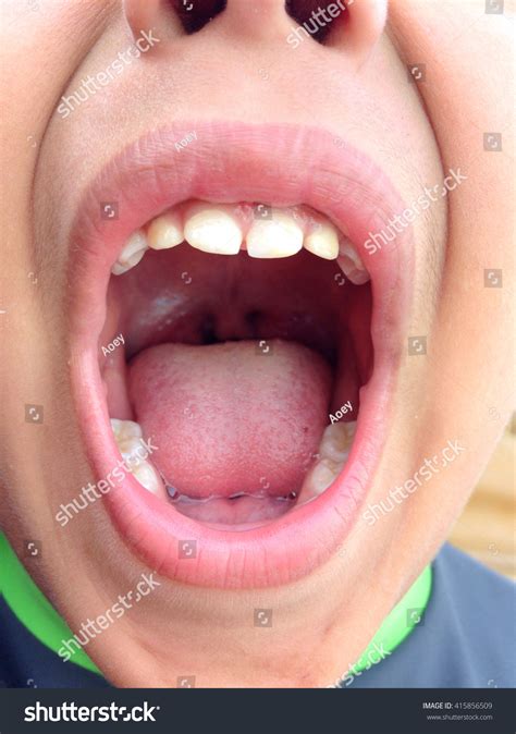 2 Caucasian Boy Uvula 图片、库存照片和矢量图 Shutterstock
