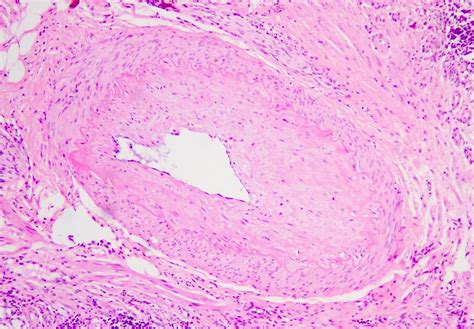 Pathology Outlines Malignant Hypertension And Accelerated Nephrosclerosis
