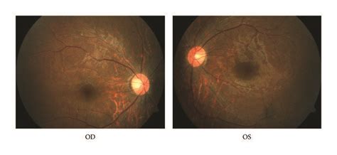 A Shows The Small Black Nodules On The Surface Of The Iris In Both Download Scientific