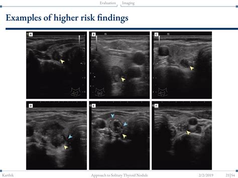 Approach To Solitary Thyroid Nodule Pdf