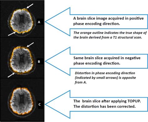 3t How To Dti Topup Distortion Correction Center For Functional Mri Uc San Diego