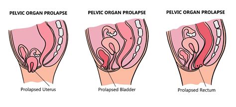 Videos Von Bladder Prolapse Pelvic Floor Prolapse Treatment Bwcc