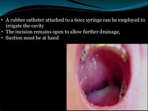 Surgical Treatment Of Paraphyrngeal And Retropharyngeal Abscesses