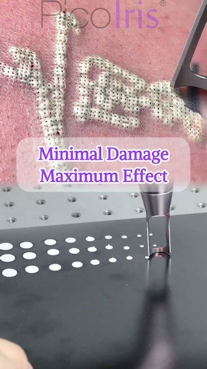 Lasertattooremoval With Picoiris 2 11mm Spot Sizes 5 Laser Modes Laserskinclinic Lasermachine