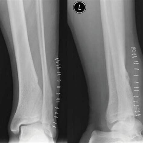 Post Operative Anteroposterior And Lateral Radiographs Download Scientific Diagram