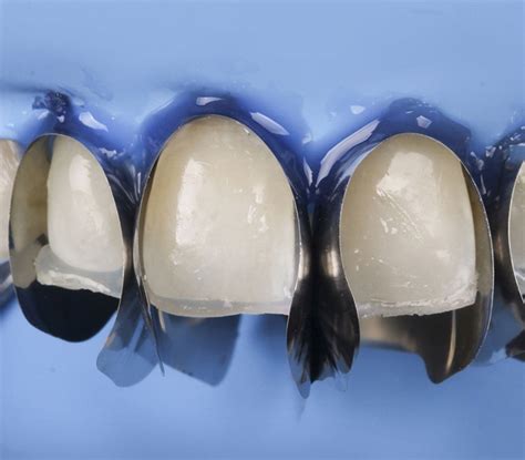 Dds Dent Anterior Matrix Dandal Prothesisc Size H Universal