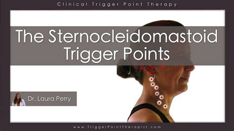 The Sternocleidomastoid Trigger Points Youtube