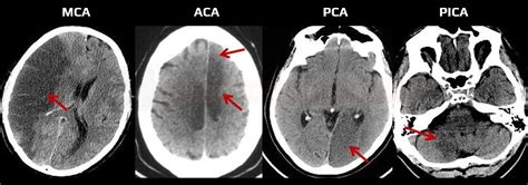 Etiologic Classification Of Ischemic Stroke Stroke Manual