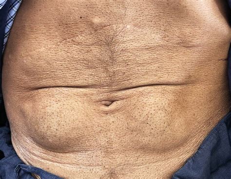 Insulin Induced Lipohypertrophy New England Journal Of Medicine