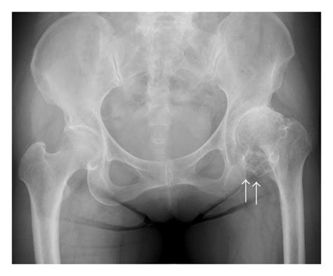 Radiographs Of The Left Hip Anteroposterior A And Lateral B Views