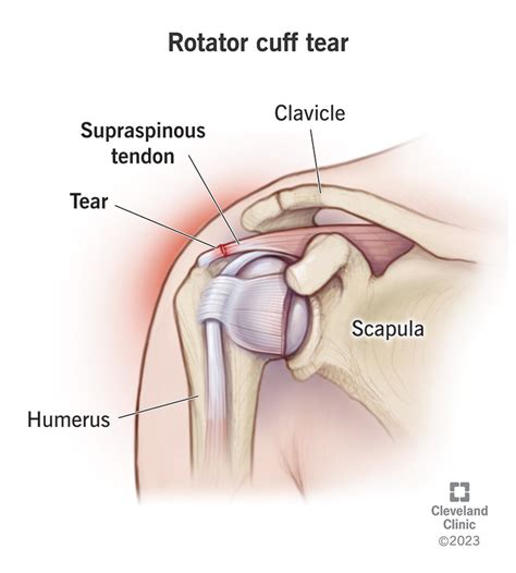 Rotator Cuff Tear Symptoms Treatment 47 Off
