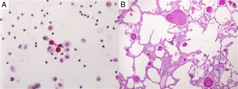 Cryptococcus Neoformans Mucicarmine Stain