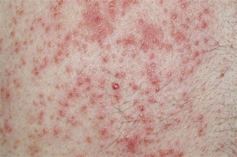 Rash Hseie