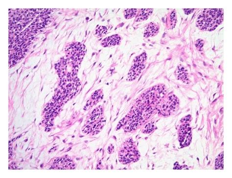 The Excised Supraclavicular Lymph Node Showed The Characteristic