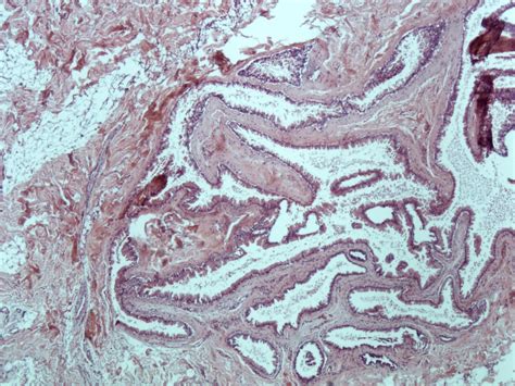 Apocrine Gland Cyst Histology