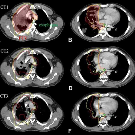 Illustration Of Interfractional Esophageal Motion And Its Dosimetric