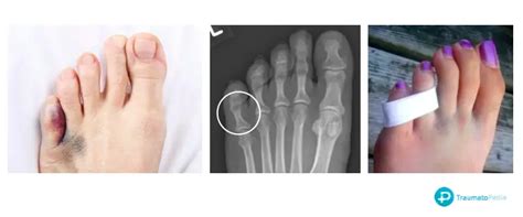 Fractura De Dedo Del Pie Radiografía Causas Síntomas Y Tratamiento