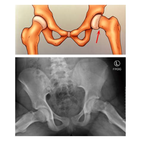 Sufe Slipped Upper Femoral Epiphysis Dr Gary Nattrass