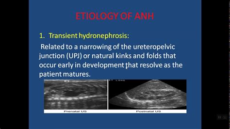 Pediatric Journal Club I Sfu Grading Of Hydronephrosis Youtube