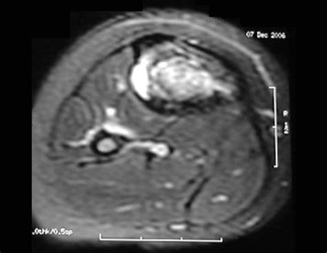 Ewing Sarcoma Of The Tibia Oncosurgery
