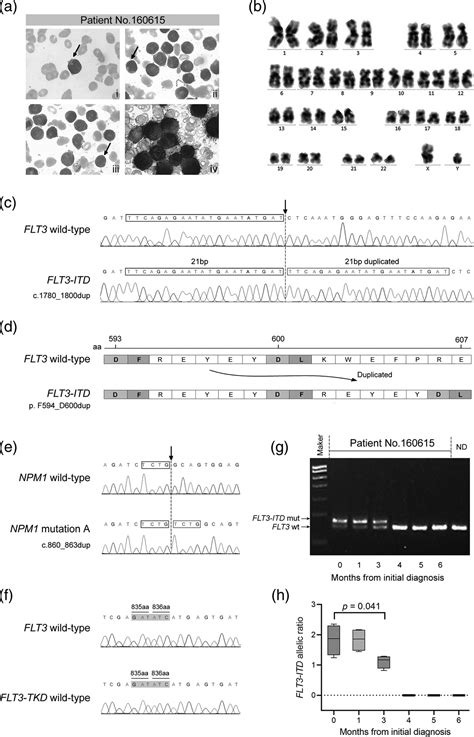 Acute Myeloid Leukemia With Cup Like Blasts And Flt3 Itd And Anti Cancer Drugs