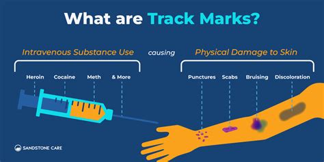 Track Marks What They Look Like And How To Recover