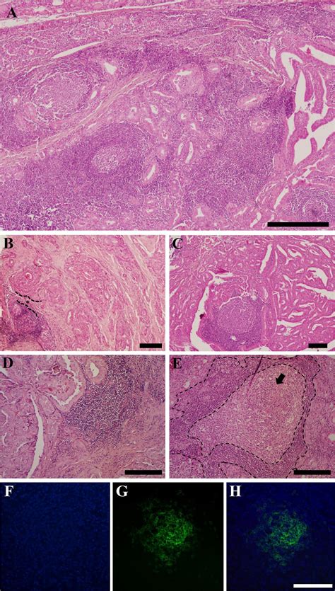 Tertiary Lymphoid Structures In Thyroid Cancer Archives Of Endocrinology And Metabolism
