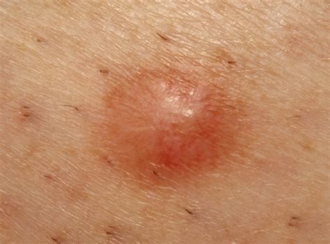 Dermatofibroma Dimple Sign