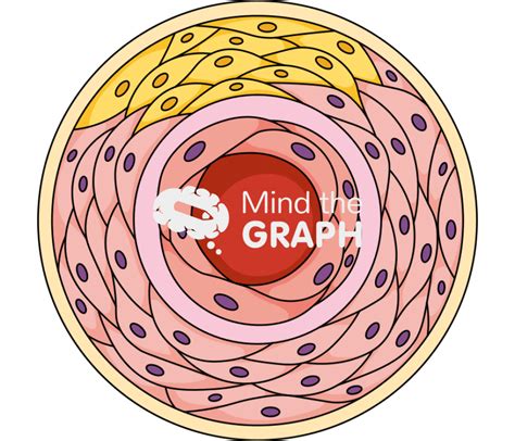 Medial Calcification