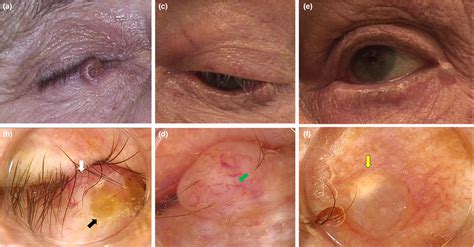 Blue Nevus Eyelid