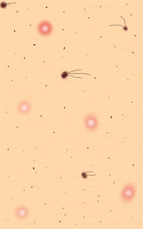 Pimple Causes Symptoms And Treatment