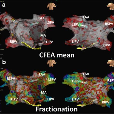 Difference Of Complex Fractionated Atrial Electrograms Cfaes Mean And Download Scientific