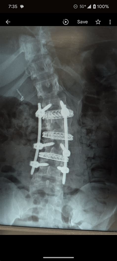 Post Op R Spinalfusion